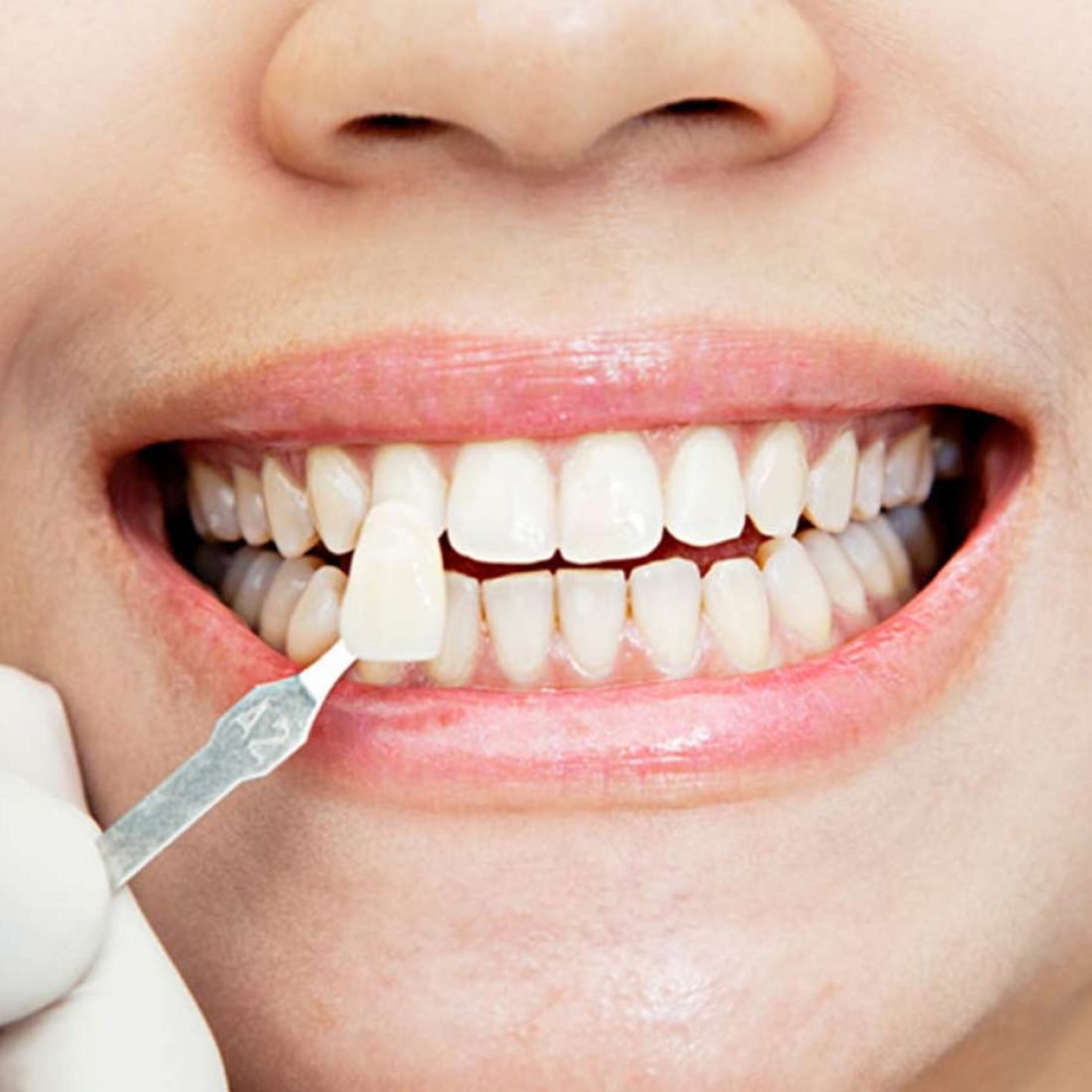 The Effects of Sugar-Free Chewing Gum on Dental Health | Exploits Valley